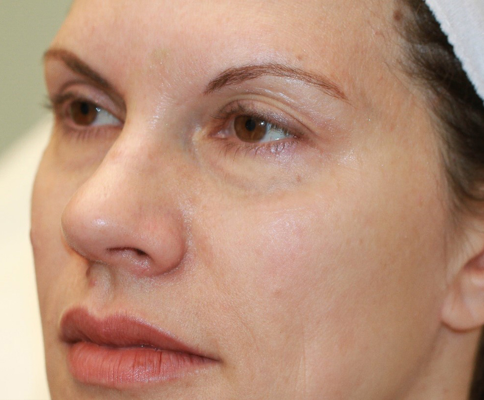 IPL Laser Treatments in Santa Cruz, CA| RSMD Medical Aesthetics