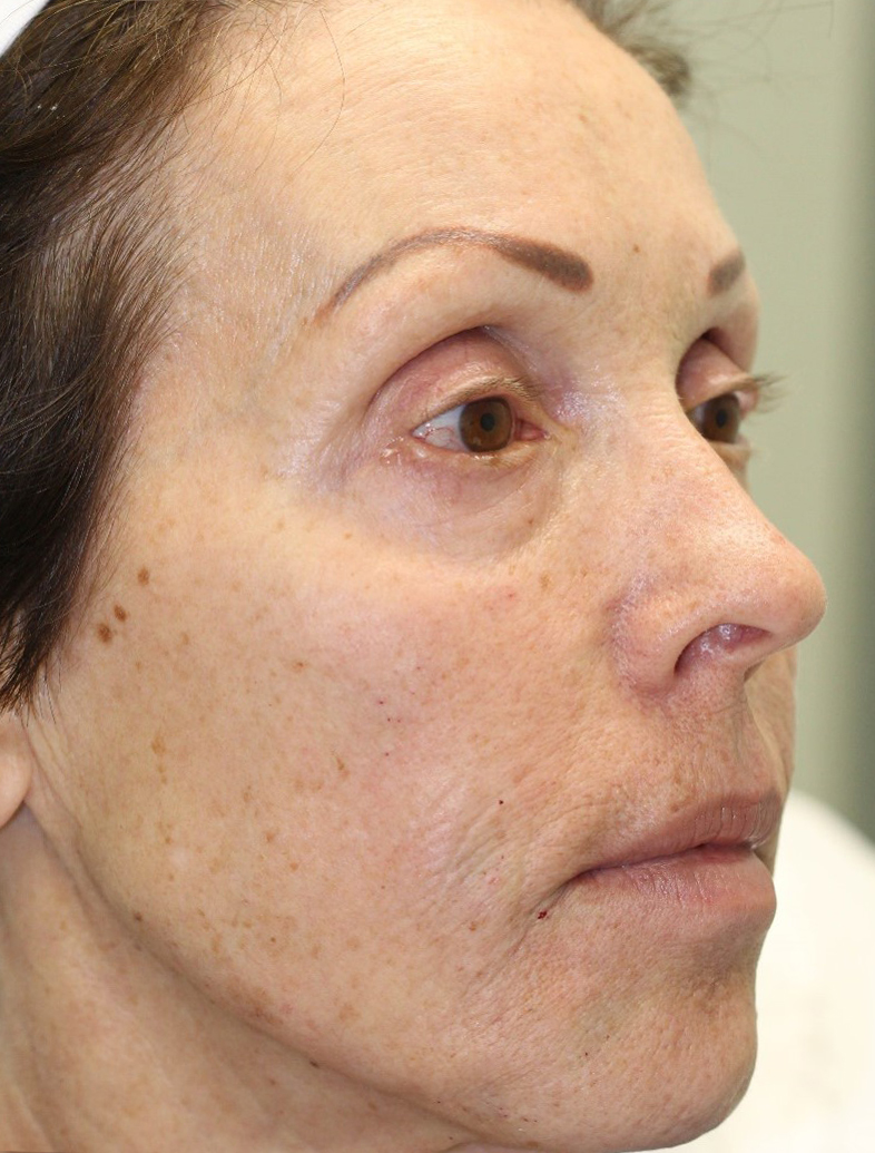 Liquid Facelift | RSMD Medical Aesthetics