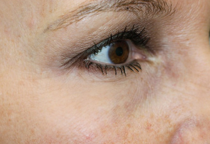 Liquid Facelift | RSMD Medical Aesthetics